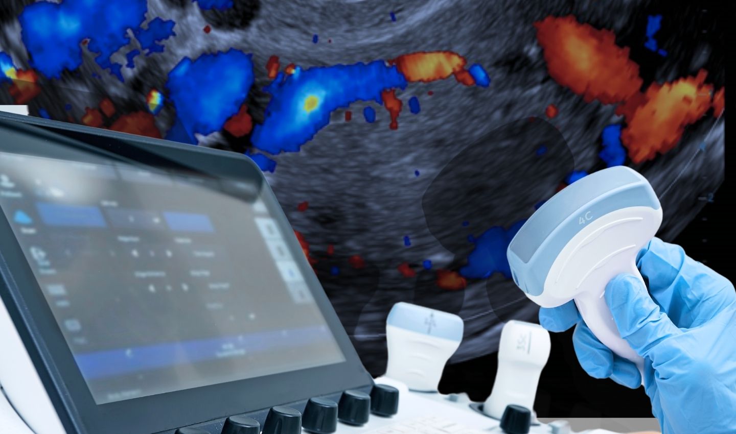 Diagnóstico De La Insuficiencia Venosa Pélvica Con Ecografía Doppler